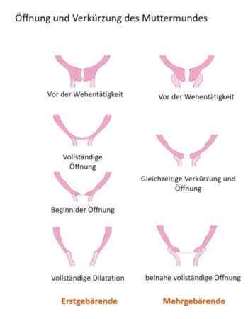 Die Eröffnungsphase: Wie verläuft diese Phase direkt vor der Geburt ...