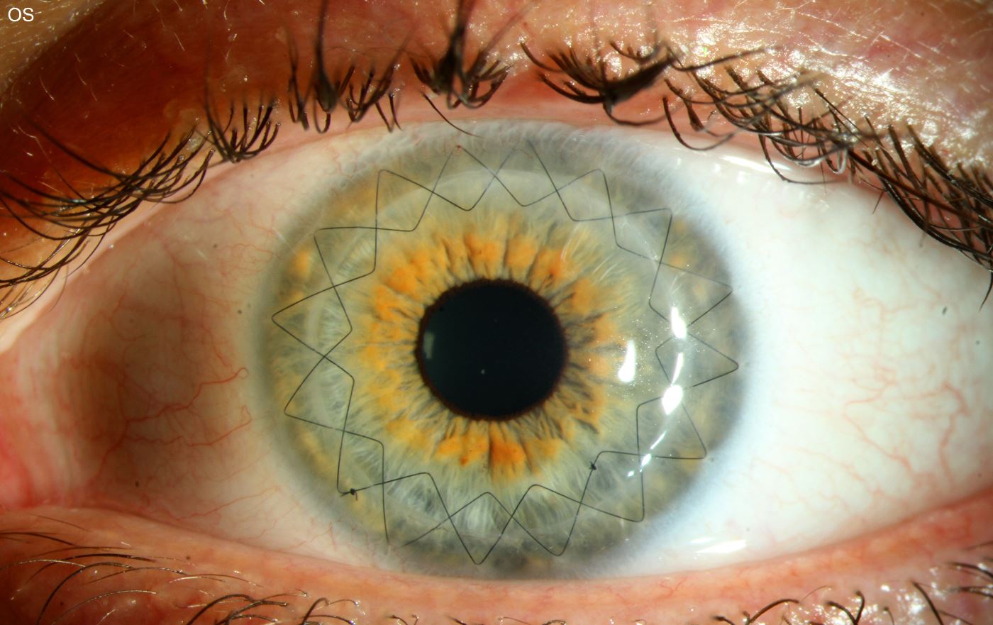 Le don de la cornée