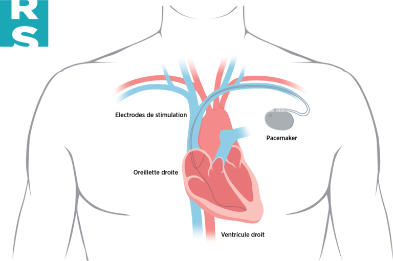 Pacemaker : l’implantation
